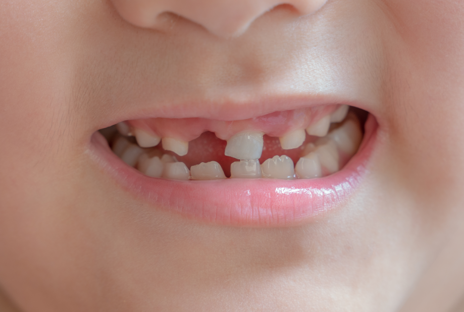 ¿Sabes qué es la agenesia dental? | Dra Patricia Otero